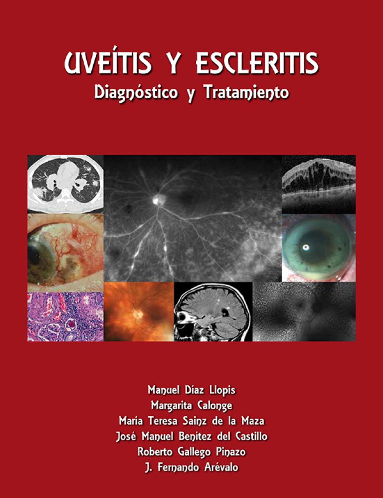 Uveítis y escleritis. Diagnóstico y tratamiento - Oftalmoseo