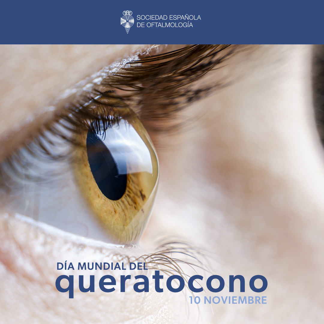 La detección precoz del queratocono, clave para frenar su avance